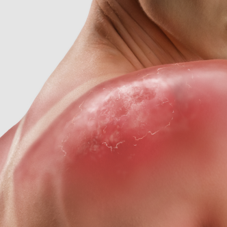 Example Case for ABSSSI Cellulitis: Severe Sunburn