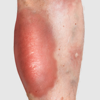 Example Patient for ABSSSI Erysipelas: Insect Bites